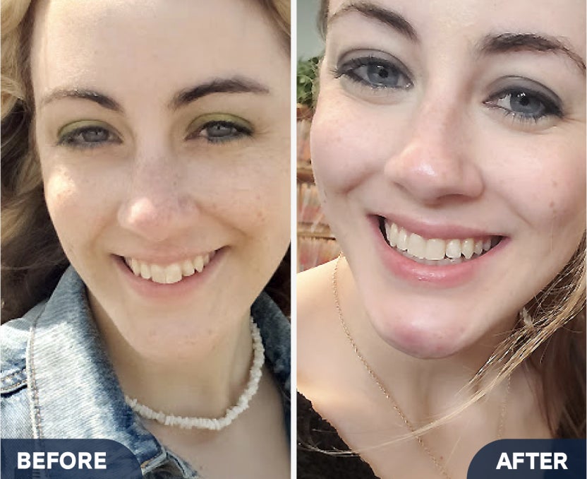 Motto Clear Aligners: Best Invisalign Alternative for Teeth Straightening