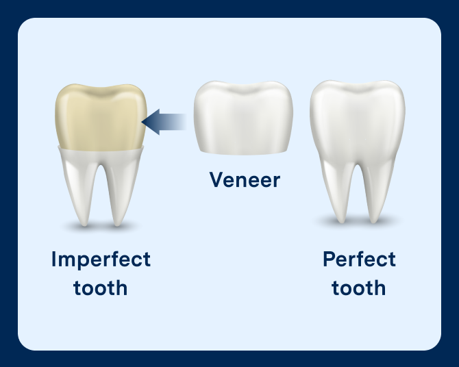 Dental Veneers: What Are Veneers?