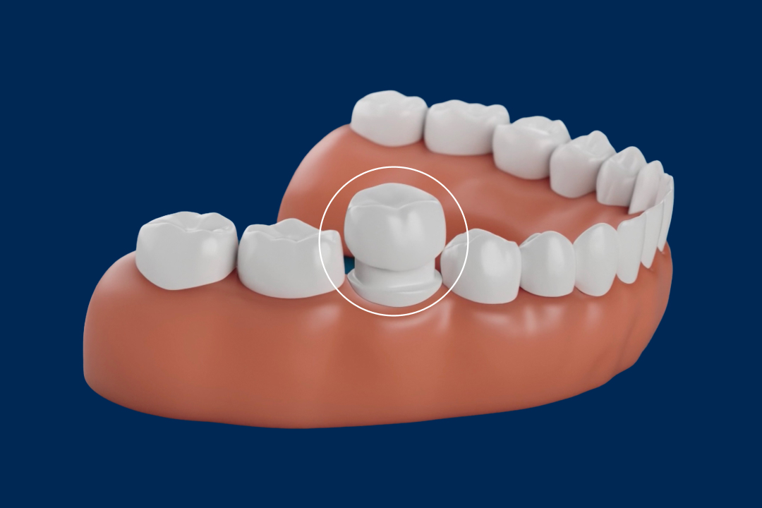 Dental Services In Auburn, MA | Aspen Dental