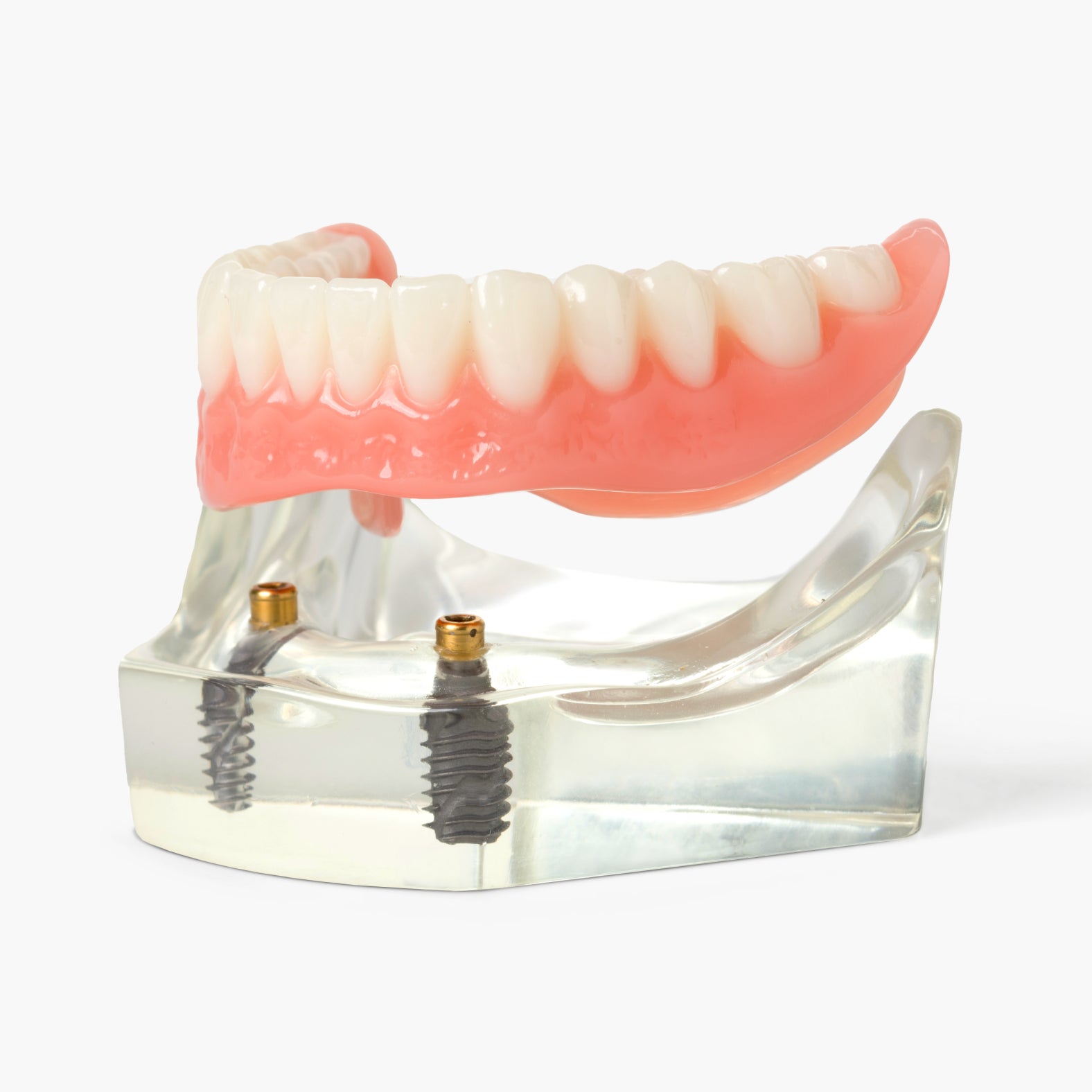 Implant Dentures – Secure, Natural-Looking Tooth Replacement | Aspen Dental