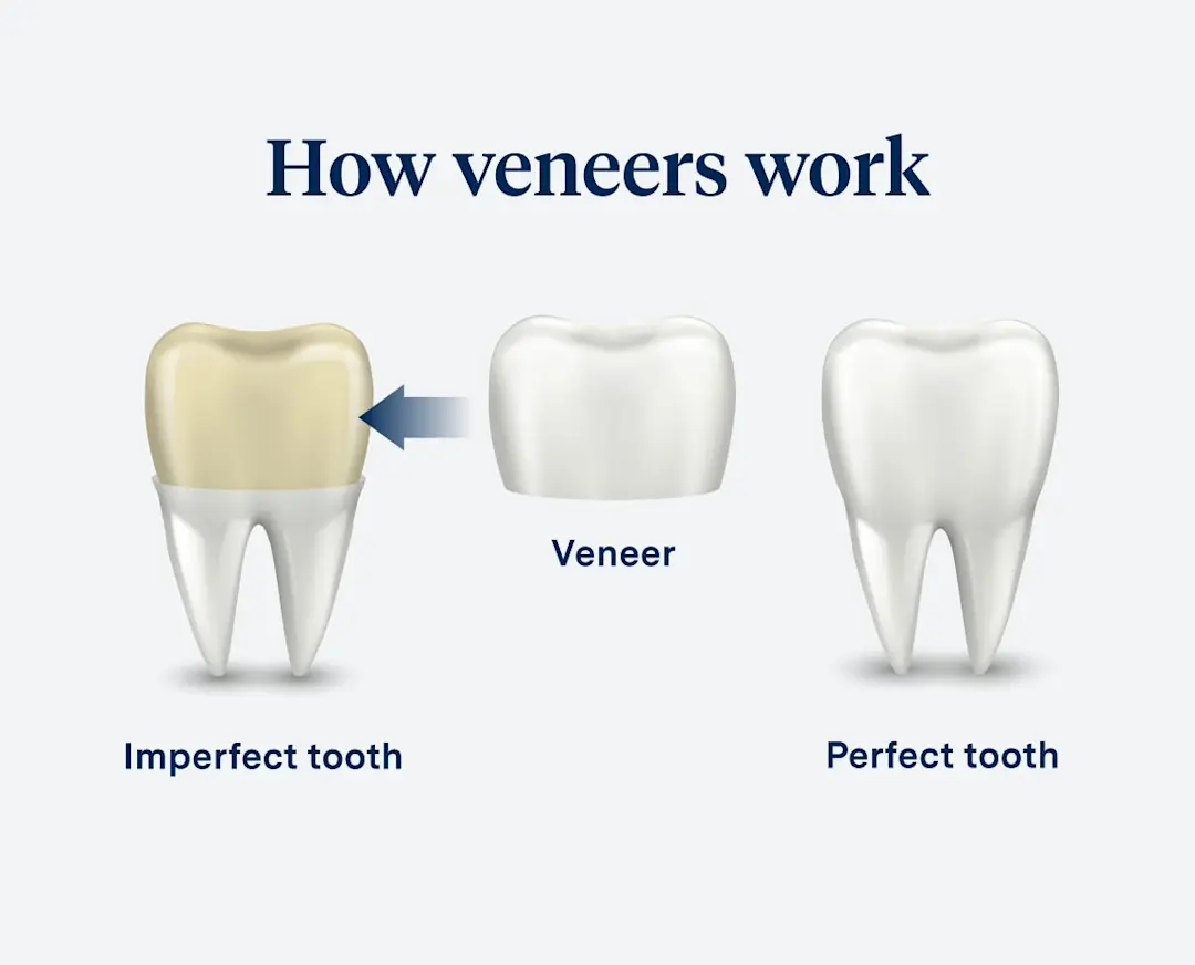 The pros and cons of dental veneers | Aspen Dental