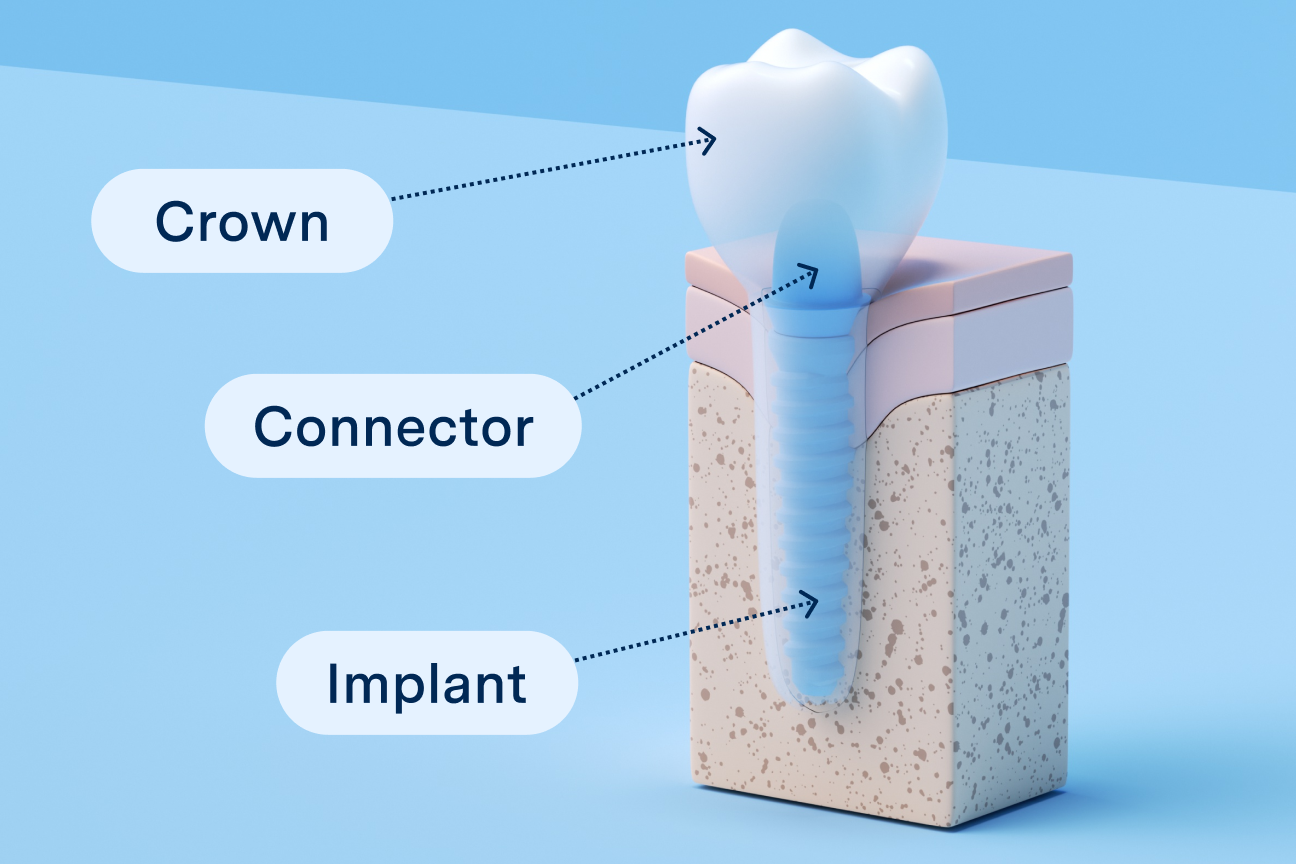 Dental Implants: Tooth Replacement Solution | Aspen Dental