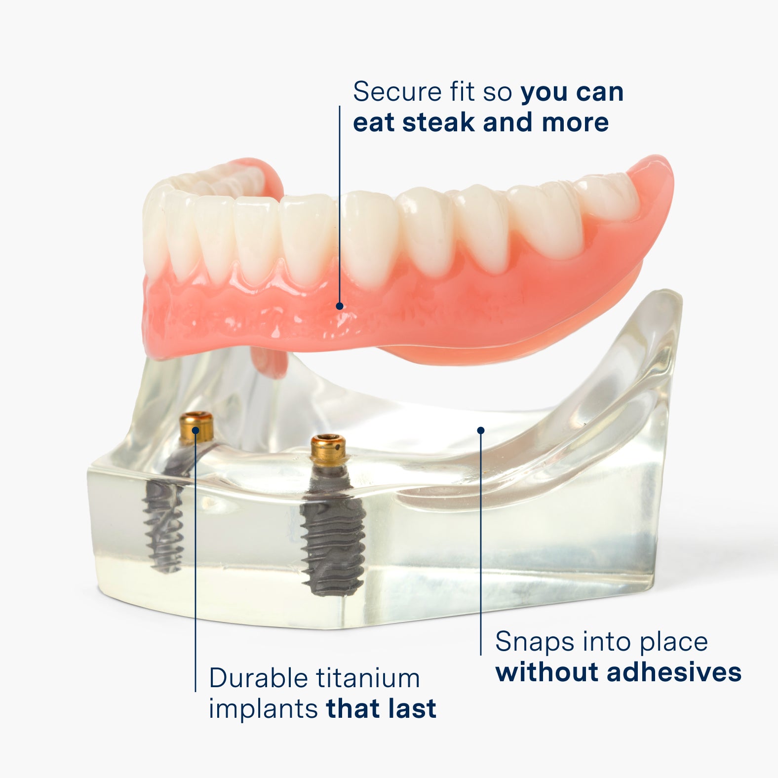 Implant Dentures – Secure, Natural-Looking Tooth Replacement | Aspen Dental