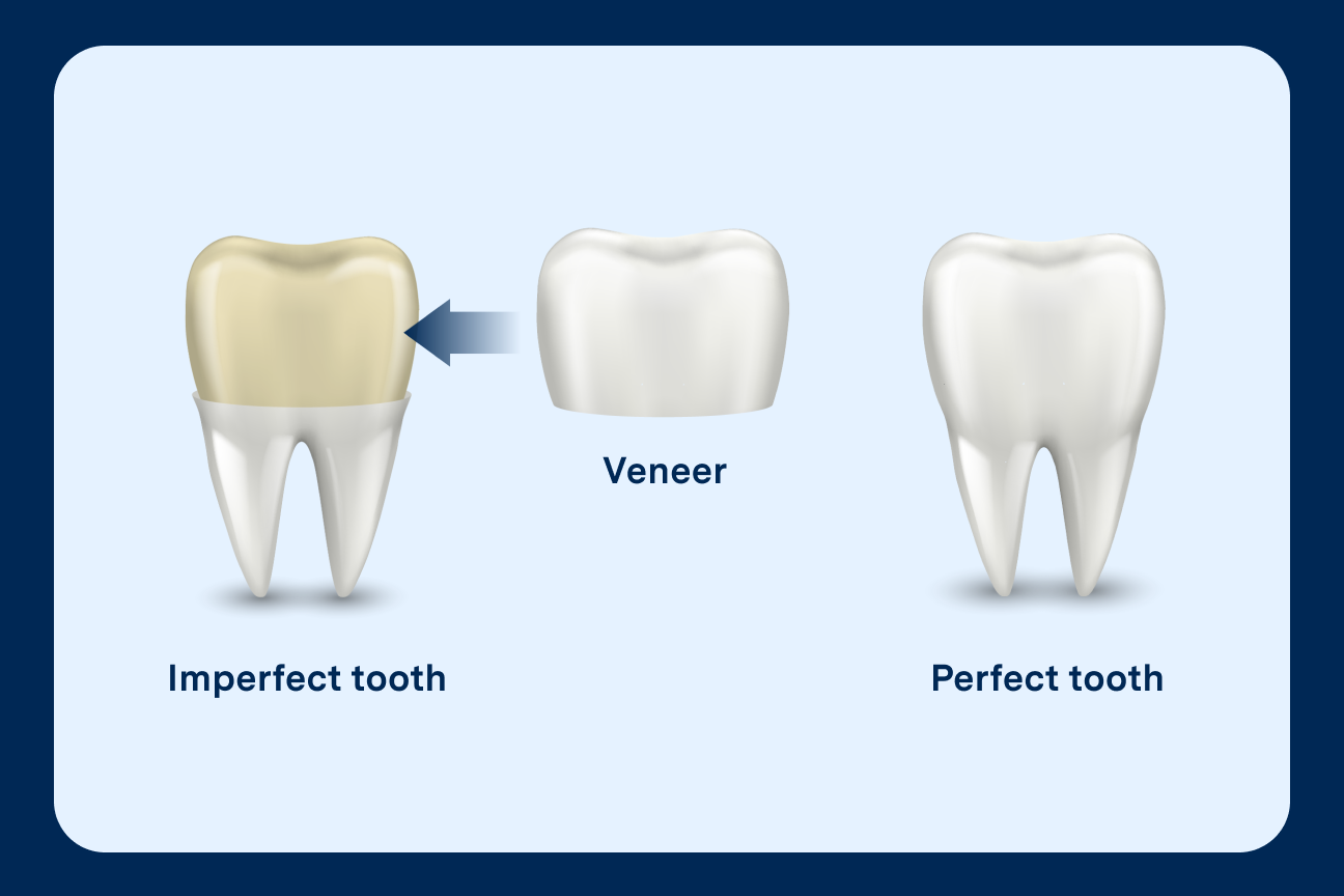 Dental Veneers: What Are Veneers?