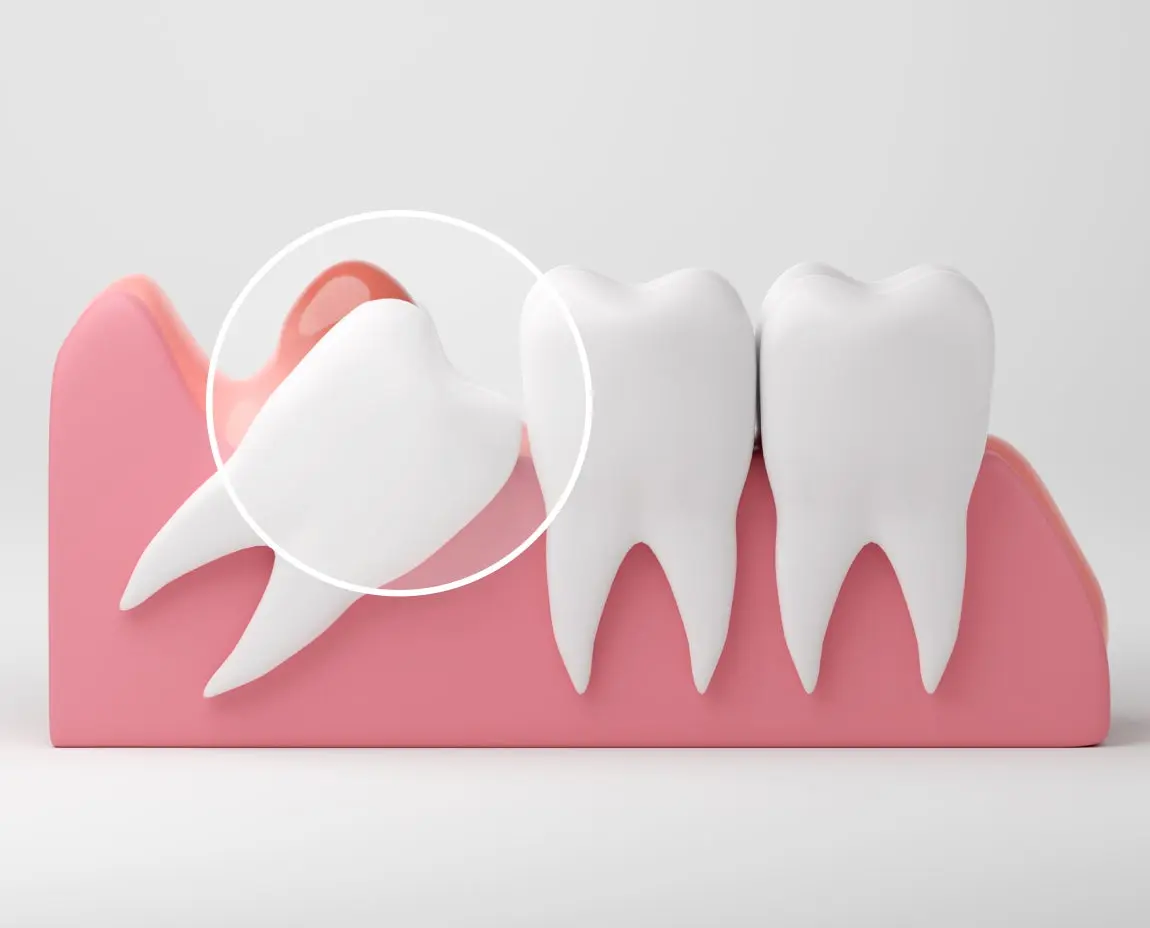 Why do wisdom teeth need to be removed? | Aspen Dental