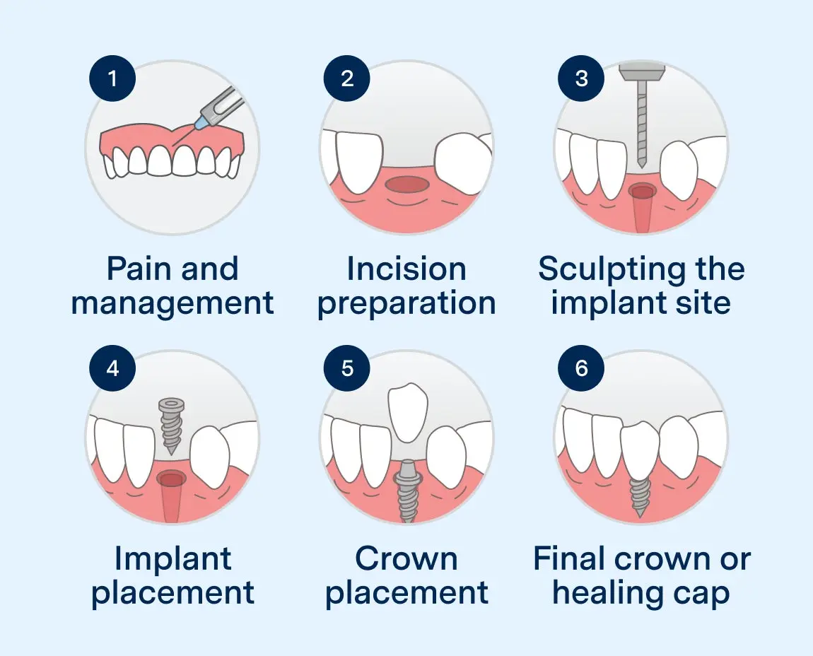 Dental implant surgery: all you need to know | Aspen Dental
