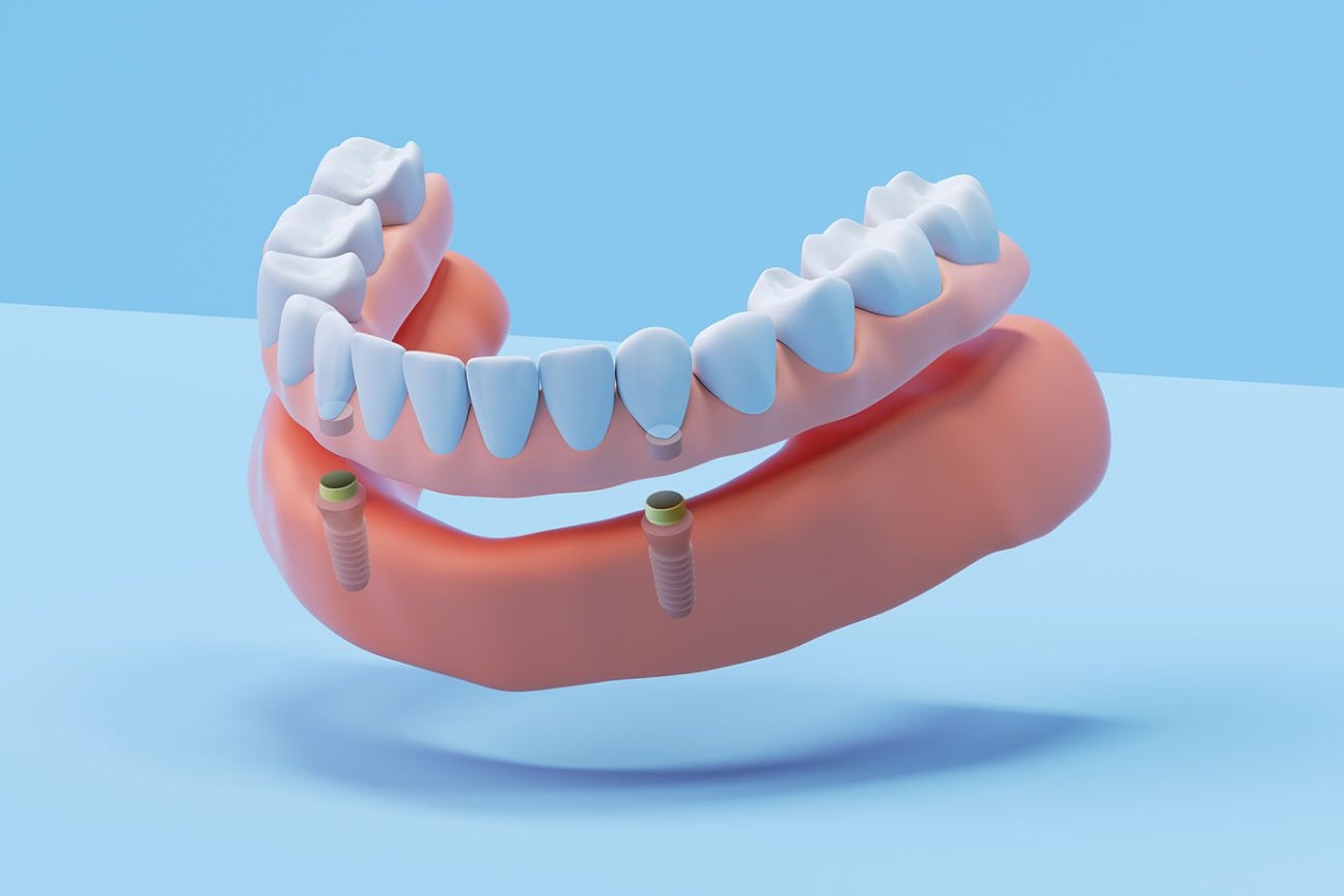 Dental Implant Types