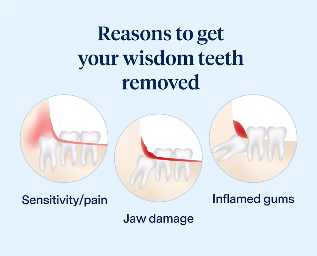 Why do wisdom teeth need to be removed? | Aspen Dental