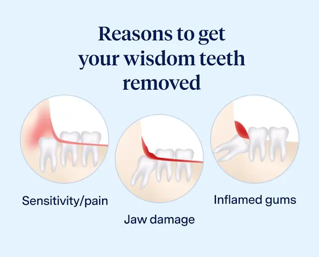 Why do wisdom teeth need to be removed? | Aspen Dental