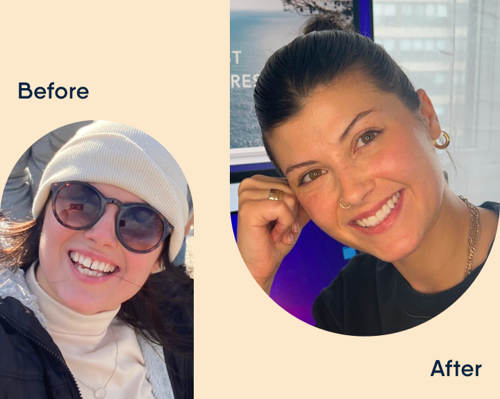 Motto Clear Aligners: Invisible Teeth Aligners from Aspen Dental