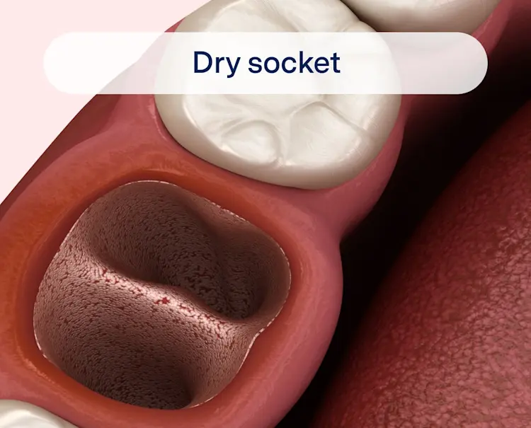 How to sleep after wisdom teeth removal | Aspen Dental