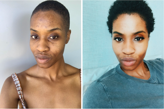 Pomade acne? Here’s what to do.. A quick guide to non-comedogenic hair