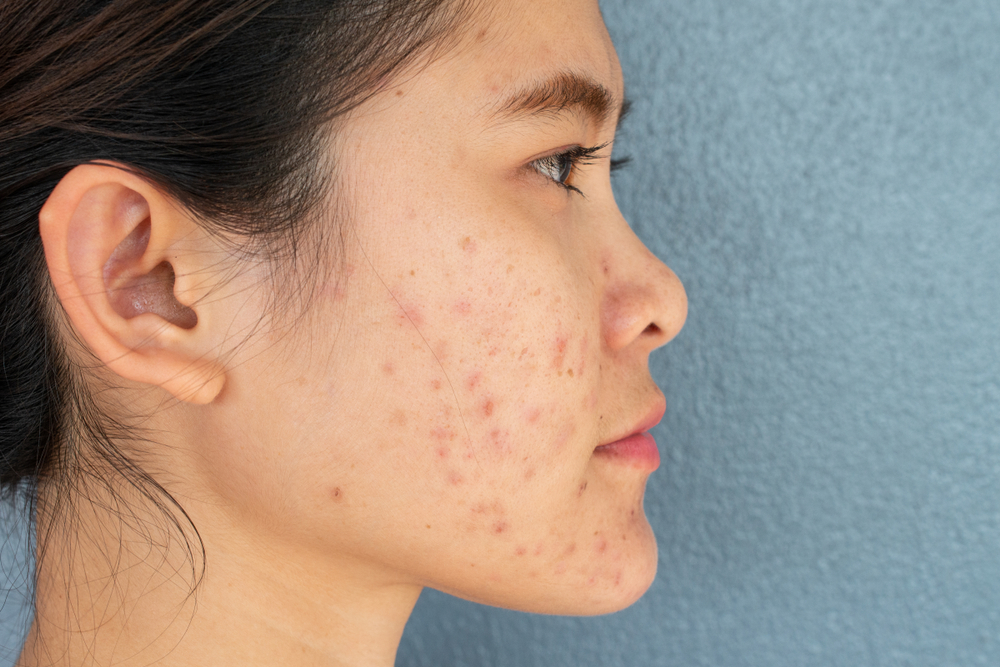Stop, don’t pop that acne papule