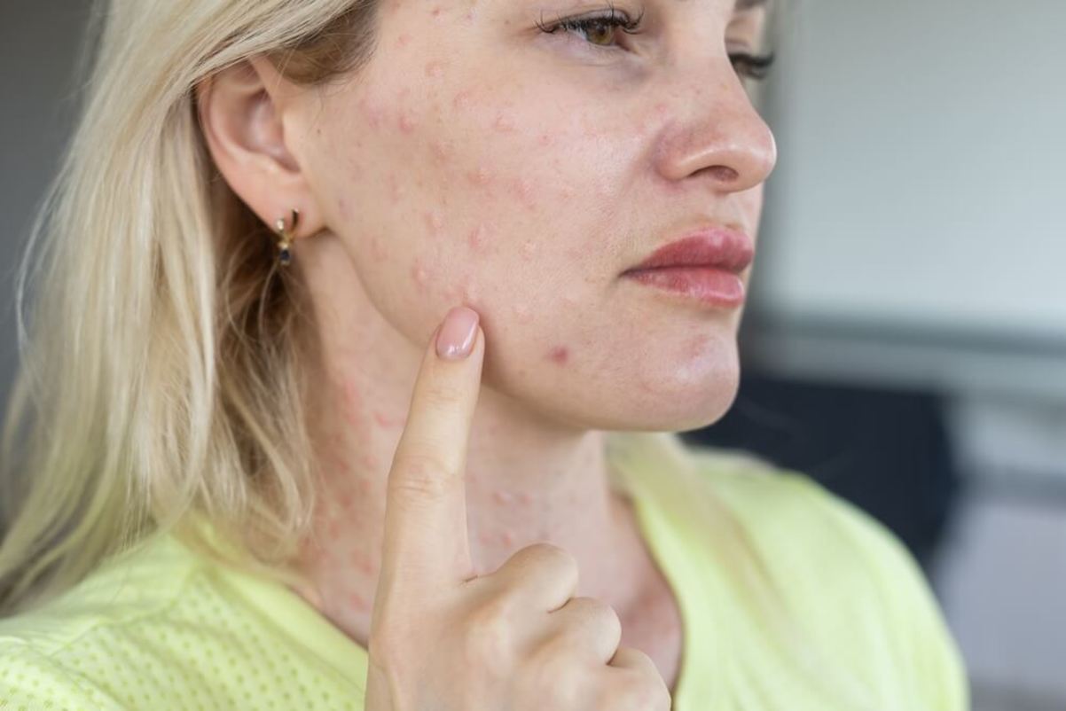 Late Onset Acne Causes And Treatments Curology