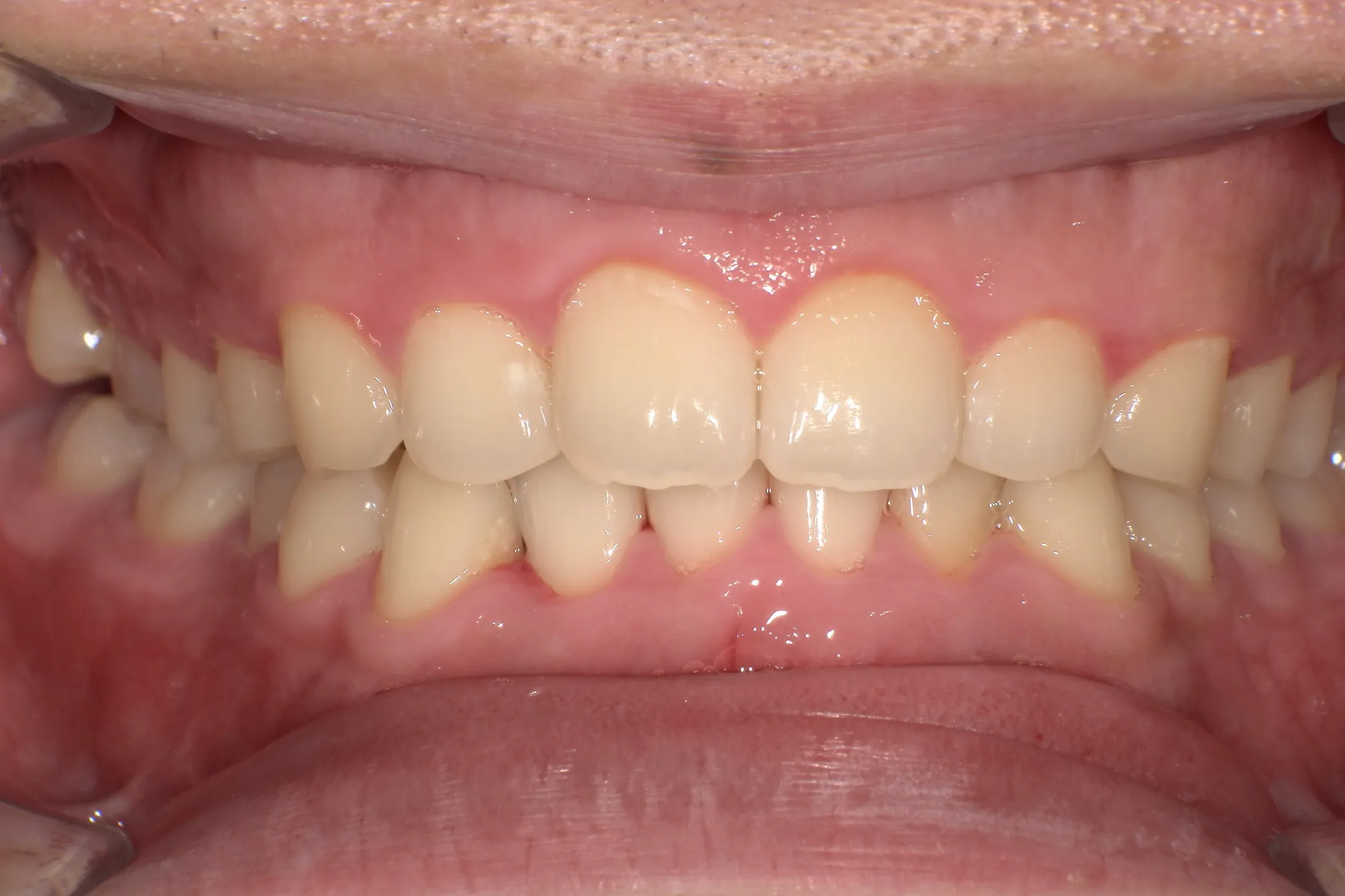 ガタガタの症例画像 | スマイルモア矯正【公式】