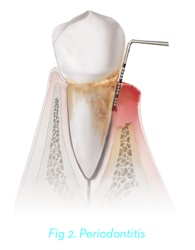 Implementing The AAPEFP Periodontal Classification System For Optimal ...