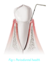 Implementing The AAPEFP Periodontal Classification System For Optimal ...