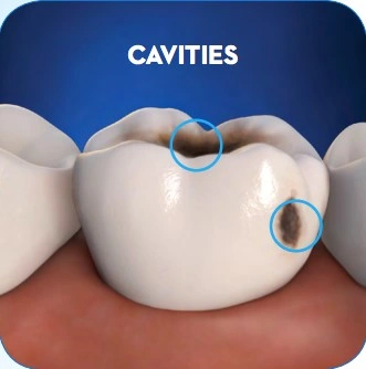 What is Plaque? | Dentalcare