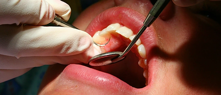 What is Plaque? | Dentalcare