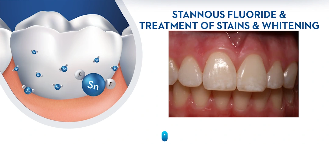 Crest's Stannous Fluoride Anti-Stain & Whitening Benefit