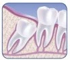 Pananakit at Pag-aalis ng Mga Wisdom Tooth - Wisdom Teeth Pain and ...