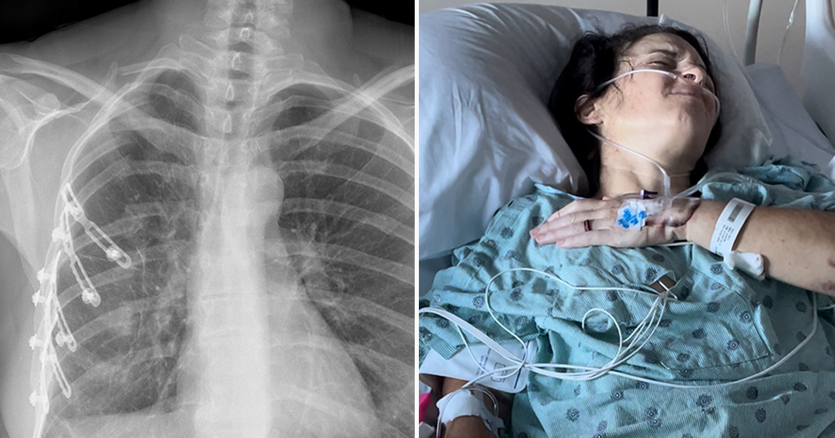 Breakthrough Medical Device Heals Broken Ribs Faster | RibFix | Medtech ...