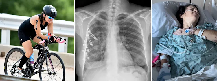 Breakthrough Medical Device Heals Broken Ribs Faster | RibFix | Medtech ...