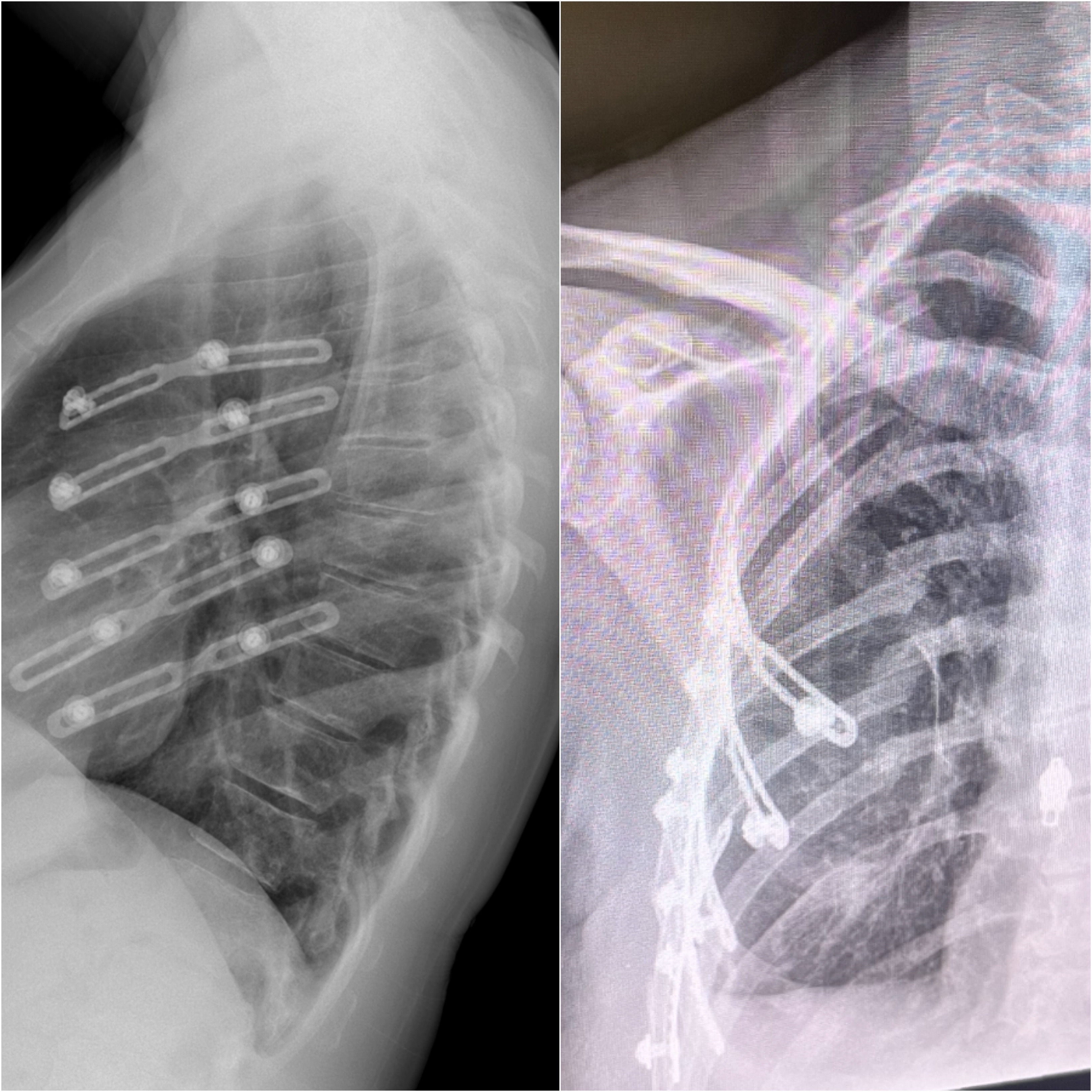 Breakthrough Medical Device Heals Broken Ribs Faster | RibFix | Medtech ...