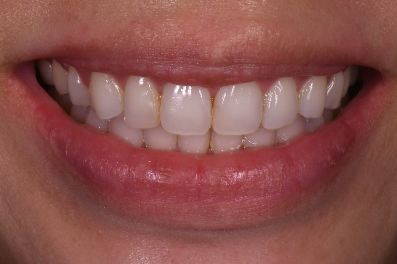 iTeroEd - Smile makeover #1 veneers