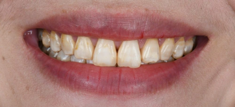 iTeroEd - Smile makeover #3 veneers