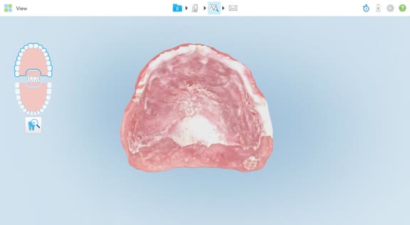 iTeroEd - Step-by-step guide: iTero scanner procedure for Denture & Removable