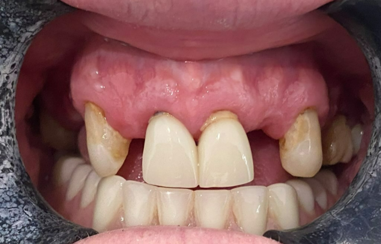 iTeroEd - Full mouth restoration #6 Removable partial denture and crowns