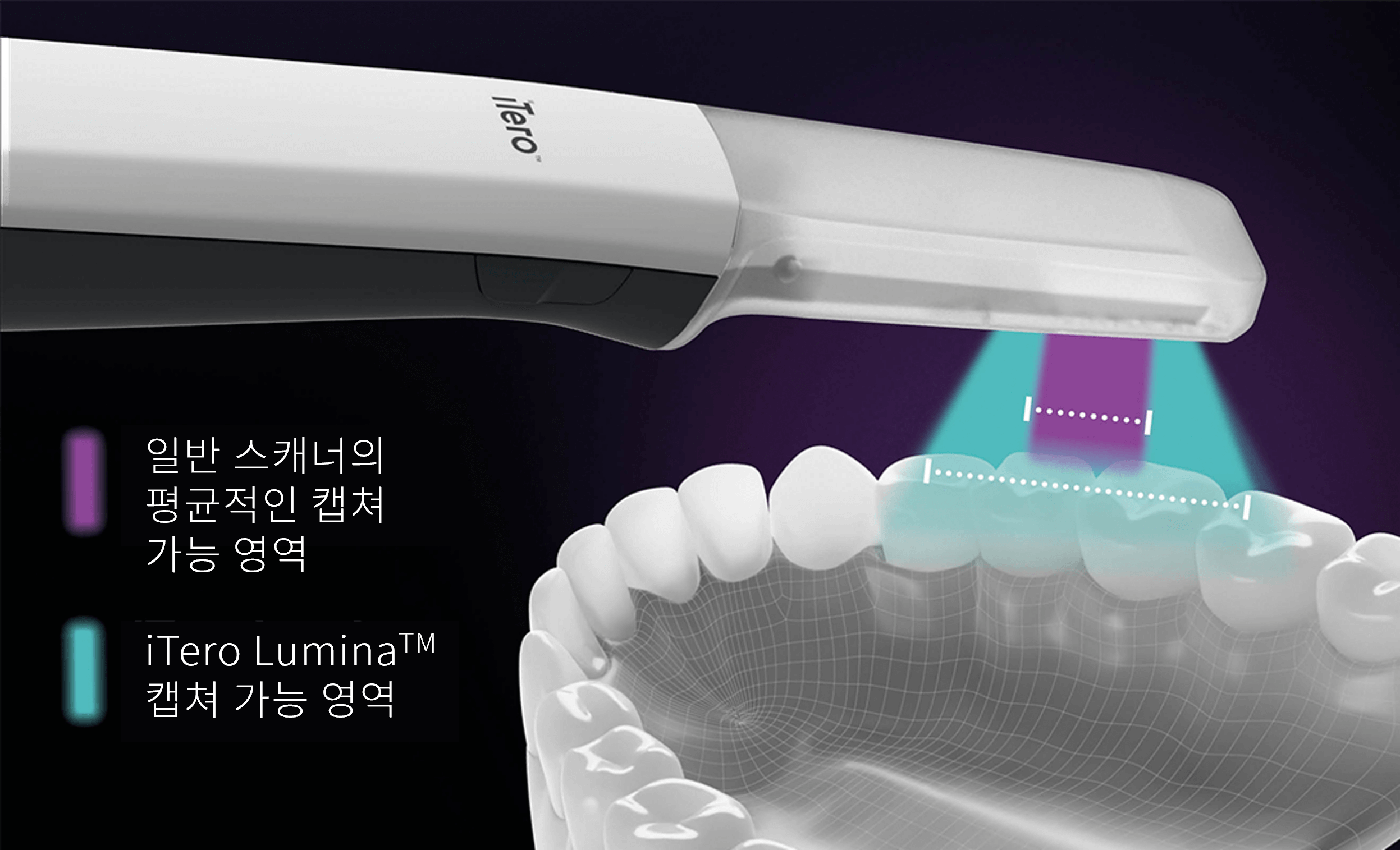 iTero Lumina™ 구강 스캐너의 작동 방식