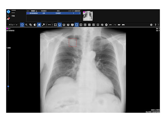 エムネスのクラウドPACS「LOOKREC」とエルピクセルの画像診断AI「EIRL」が連携、AI活用をシームレス化 | m3.com AI Lab