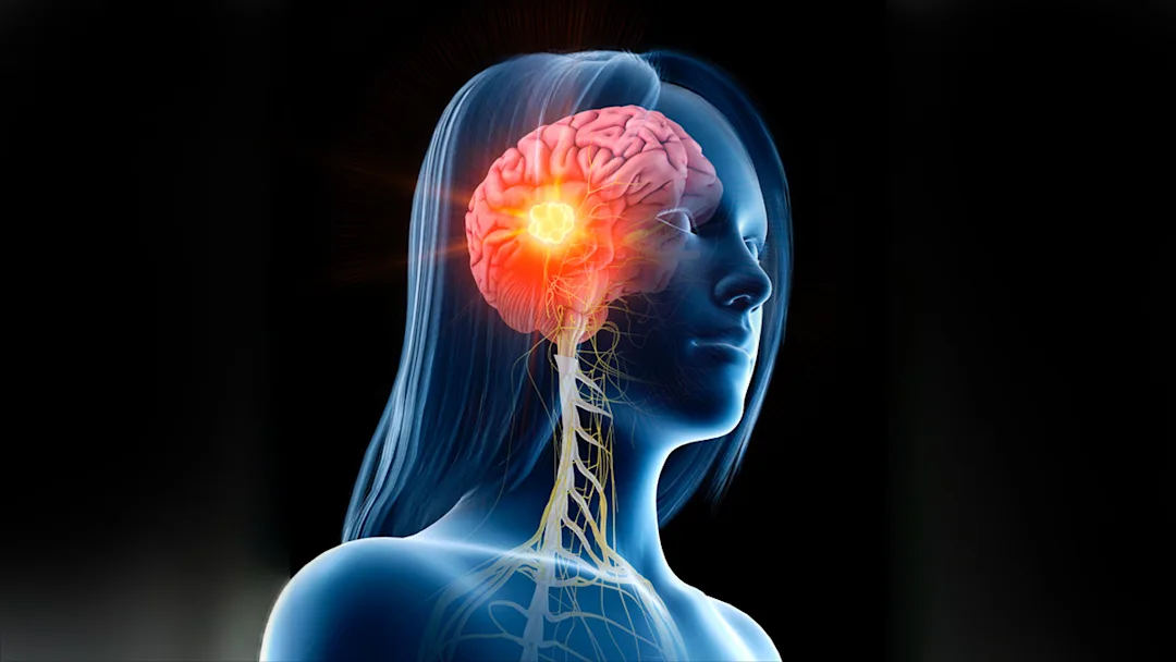 How Neurological Diseases Differ in Women