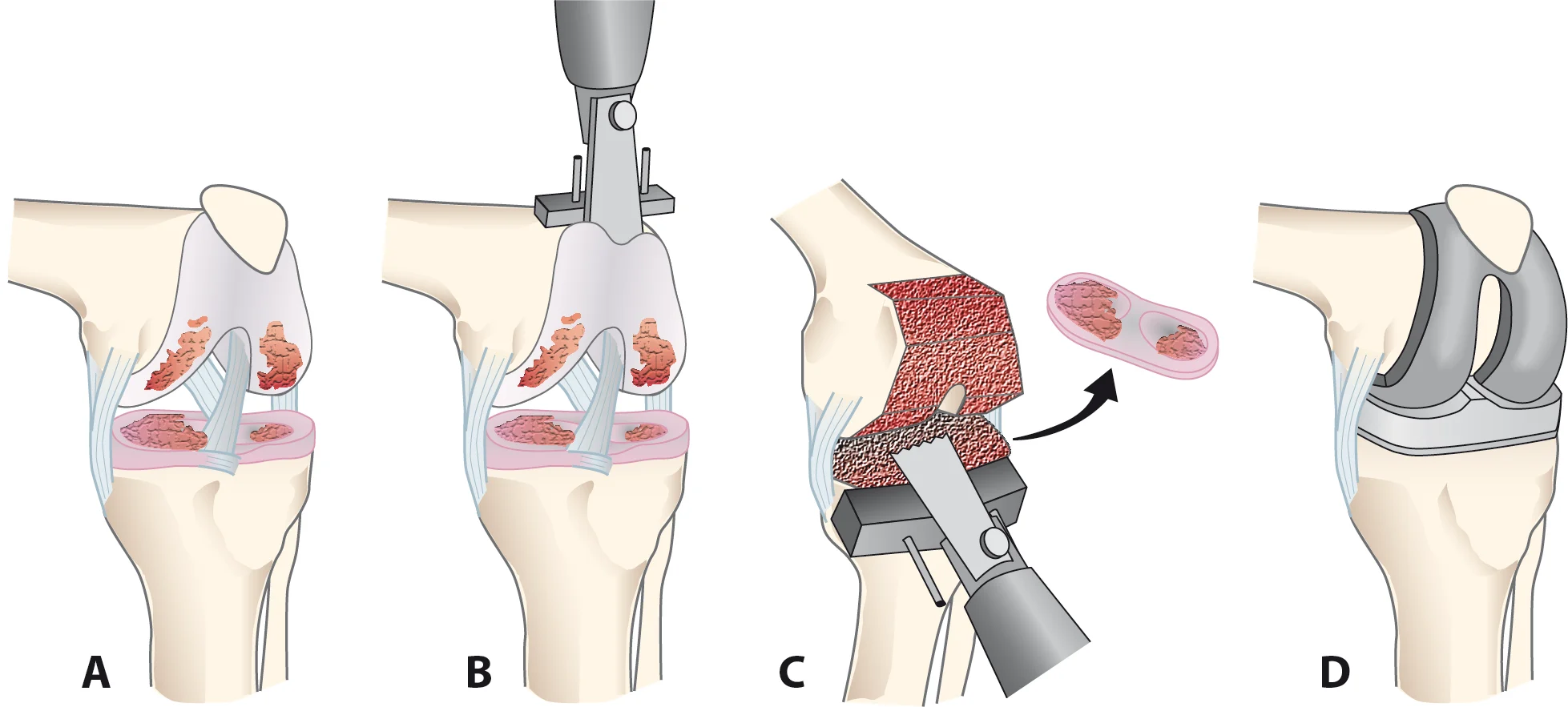Polven tekonivelleikkaus | Pihlajalinna