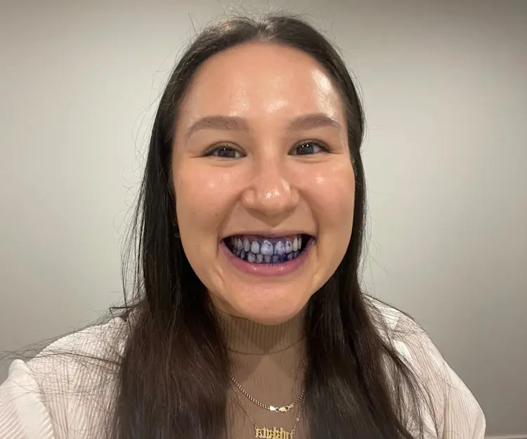 HiSmile V34 Review: Whitening Results - Adore Beauty