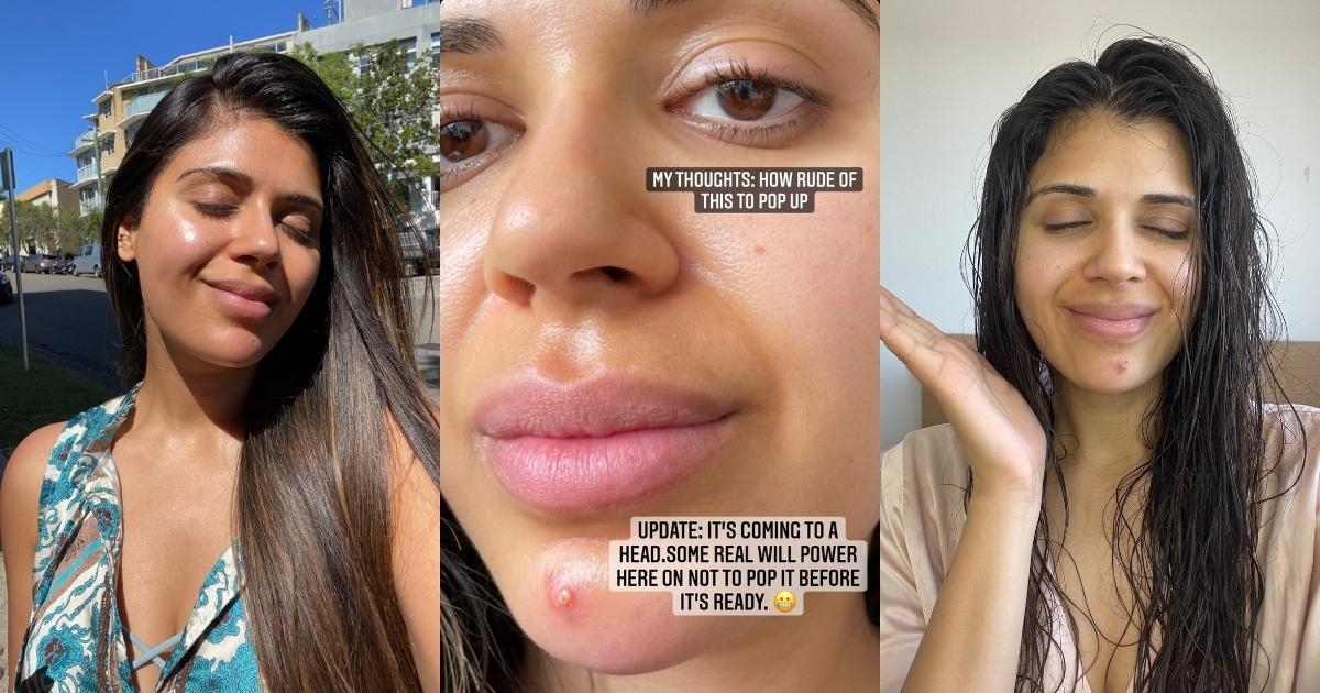 How to Get Rid of Pimples Overnight: Quick Tips - Adore Beauty