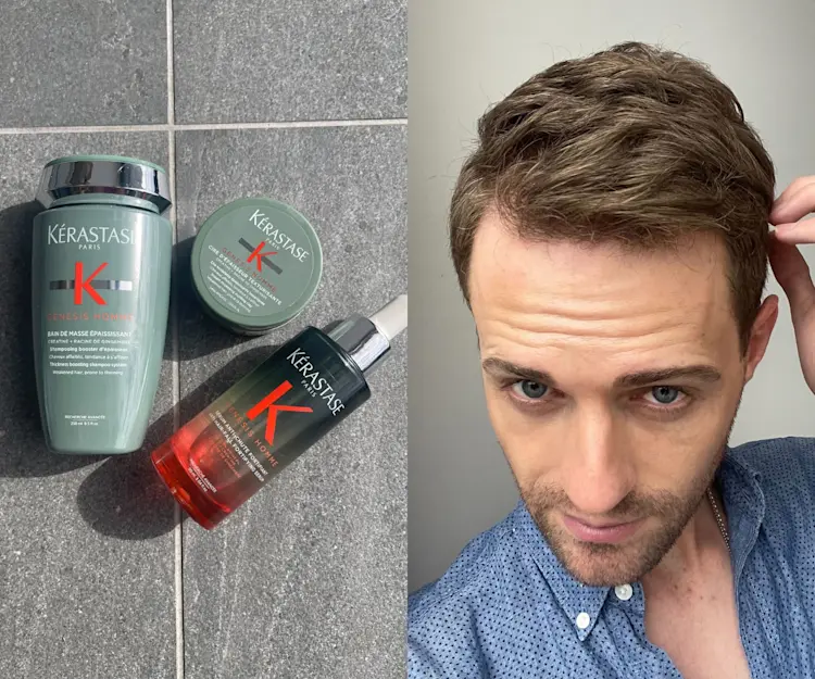 I’ve Tried Everything to Stop Hair Fall. Now I’m Trying This New ...