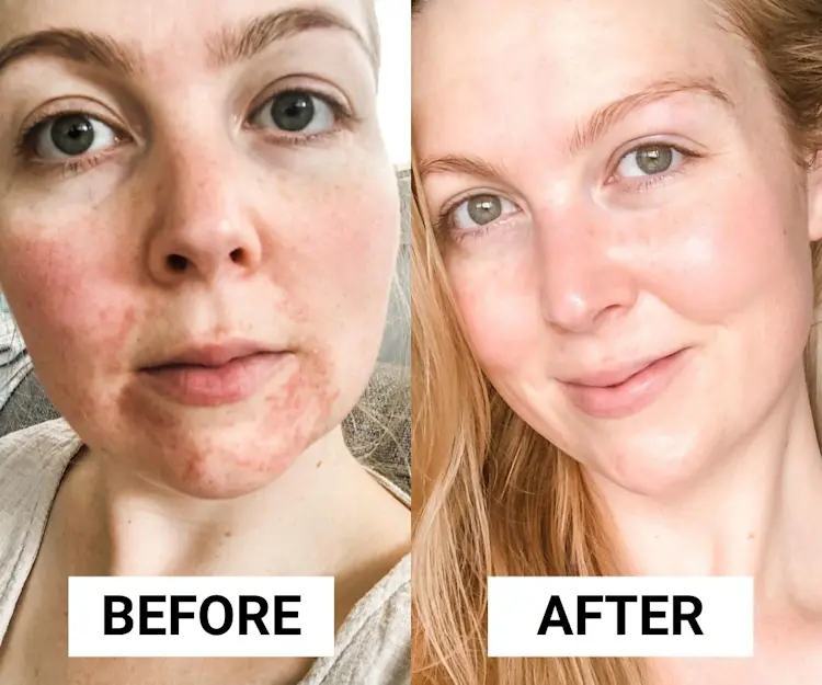 Perioral Dermatitis Skin Care Tips - Adore Beauty