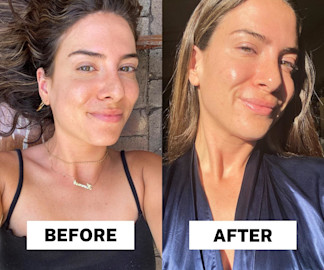 An Honest Guide to Skin Needling, My Favourite Skin Treatment of All Time