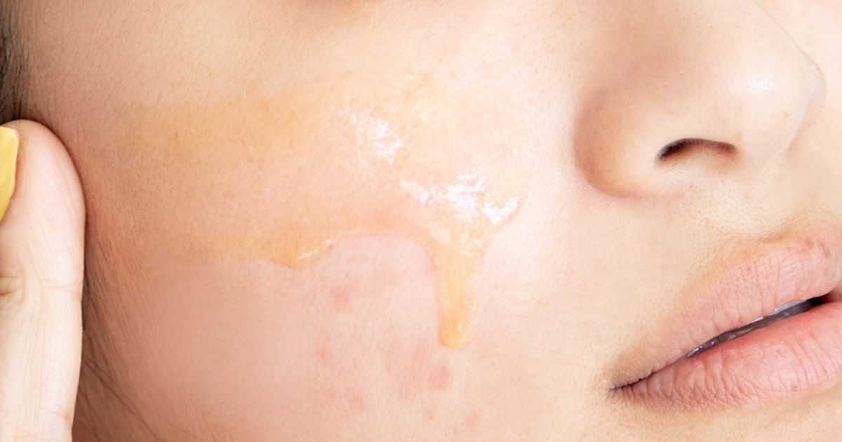 A Dermal Therapist Answers Your Post-Inflammatory Hyperpigmentation ...