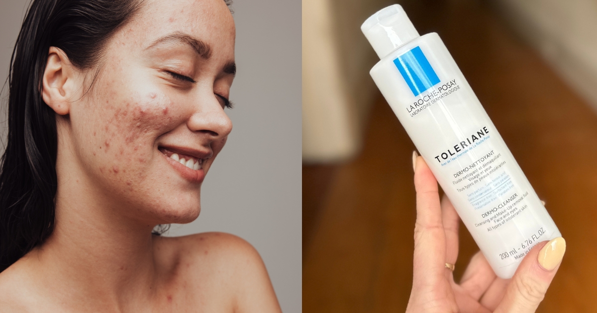 Best skincare acne under $100