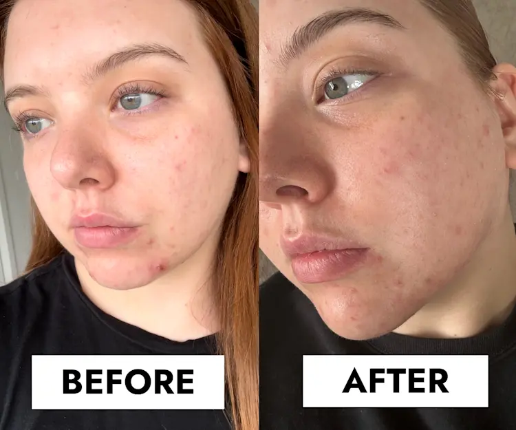 The Liberty Belle Rx Morning Skincare Routine My Blemish-Prone Skin Is ...