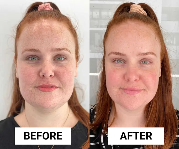 What Is Fraxel Laser? My Review + Before & After Results!