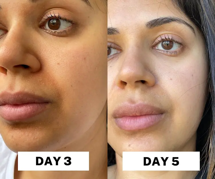 Exactly How I Fixed My Destroyed Skin Barrier in a Week