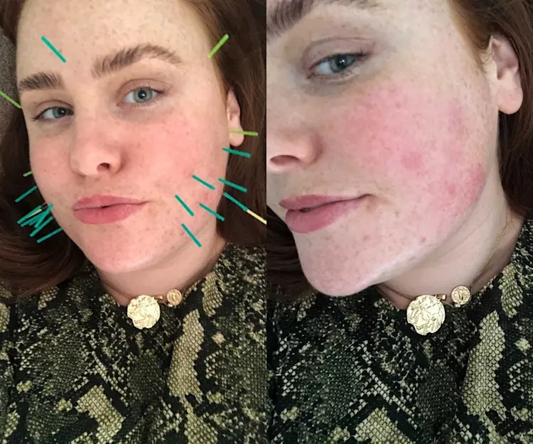 Exactly What Happened When We Tried Cosmetic Acupuncture for the First Time