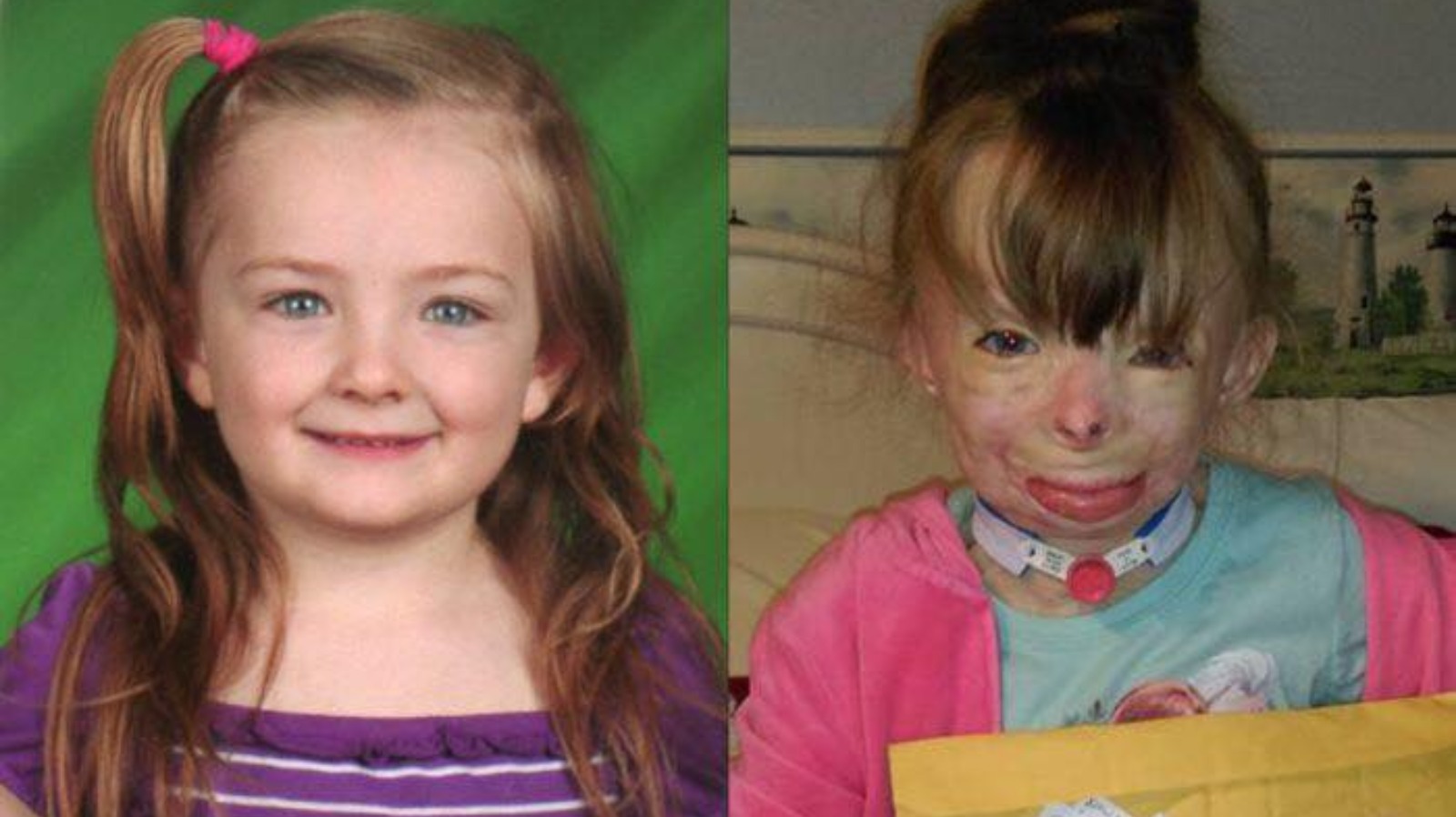 Badly burned girl, 8, who wished for Christmas cards receives surprise ...