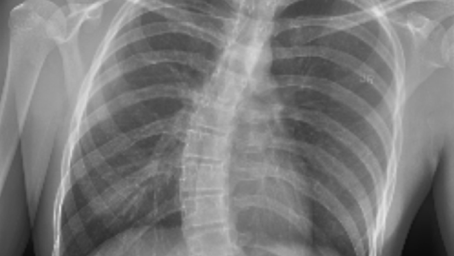 Young gymnast fundraising to correct twisted spine | ITV News Calendar