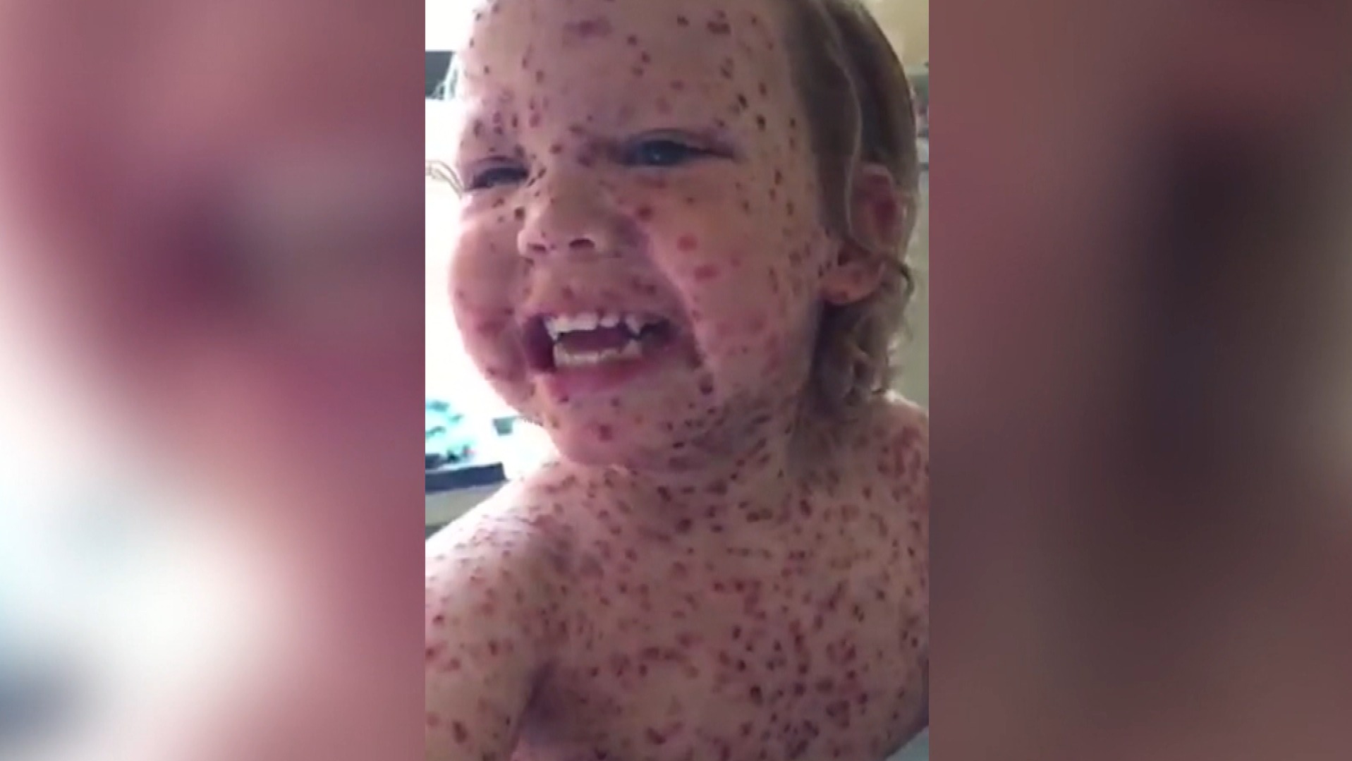 Cambridgeshire mum calling for free chickenpox vaccine | ITV News Anglia